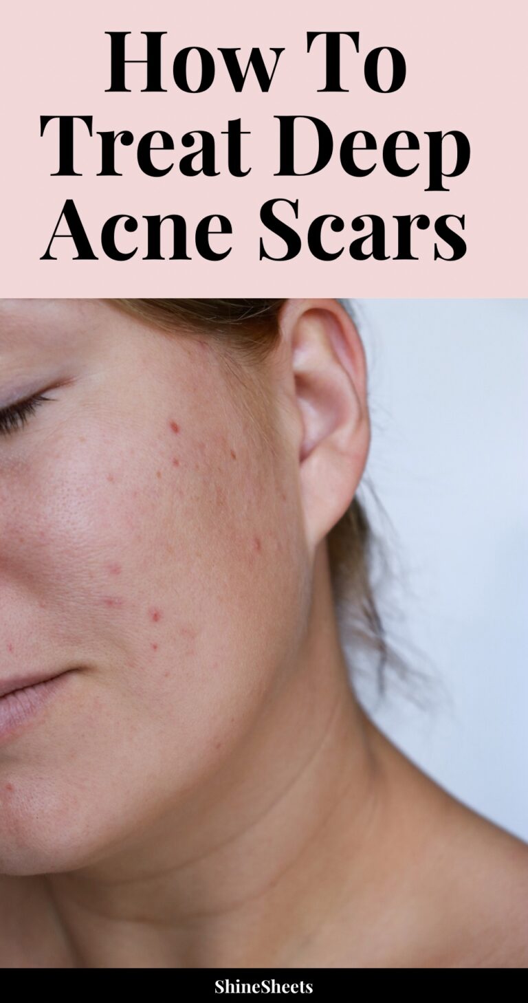 7 Best Treatments For Deep Acne Scars | ShineSheets - Elevate Your Life